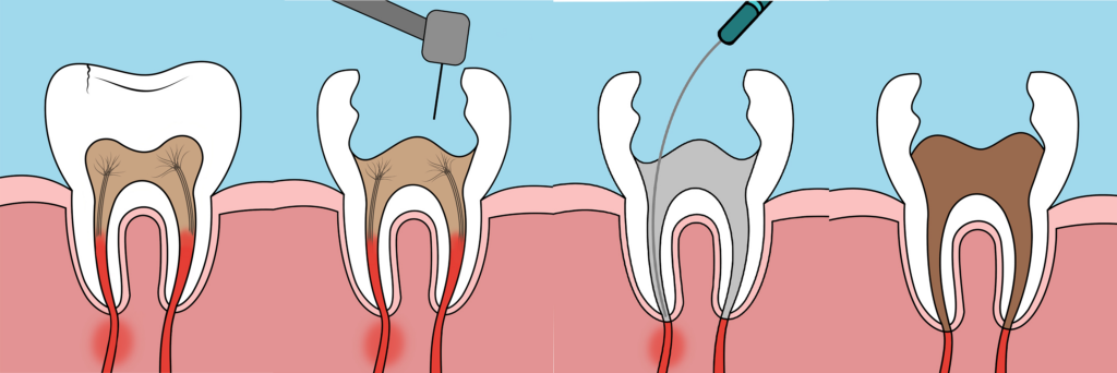 Rodbehandling - Sønderborg Tand